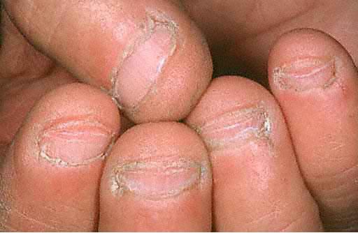 Nail Problems