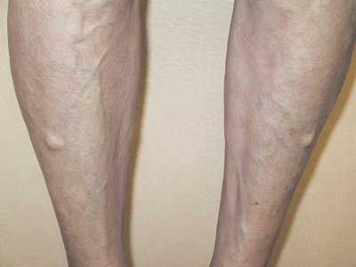 Varicose Veins